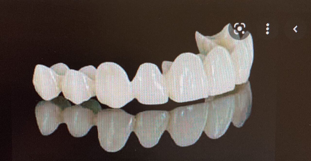 Puentes dentales - Clínica Ulman